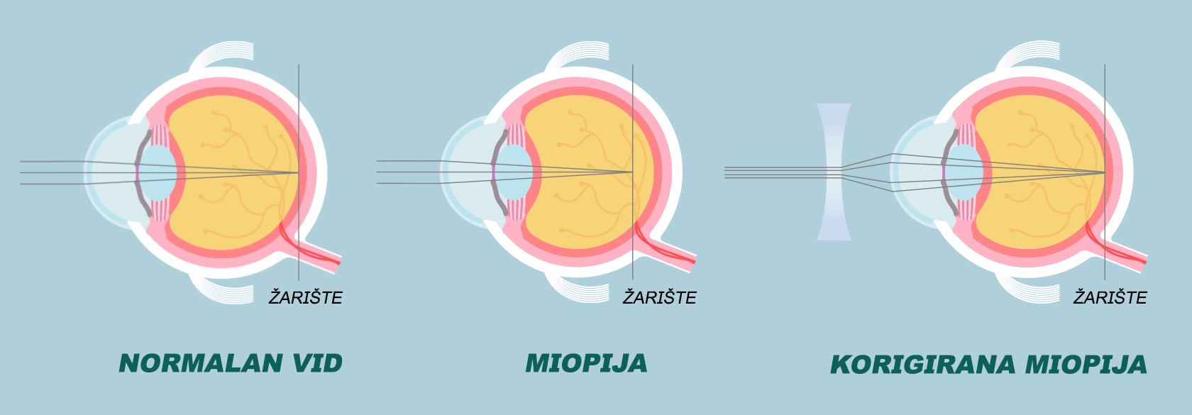 Što je kratkovidnost (miopija)? - Optika Optotip